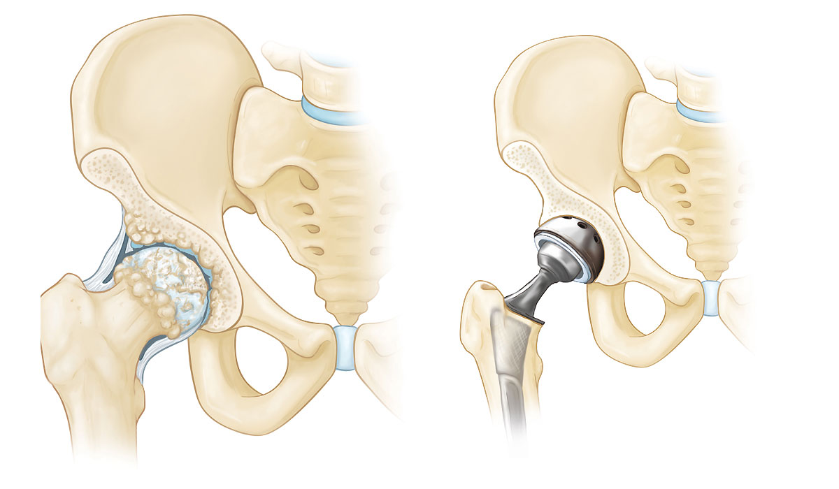 A Guide to Joint Replacement - Medical India Tourism