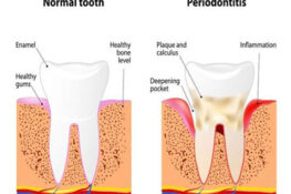 Optical Internal Urethrotomy (OIU) in India | Medi Connect India