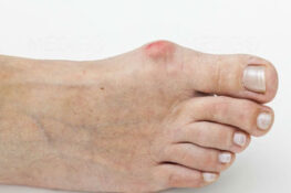 Optical Internal Urethrotomy (OIU) in India | Medi Connect India