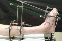 Optical Internal Urethrotomy (OIU) in India | Medi Connect India